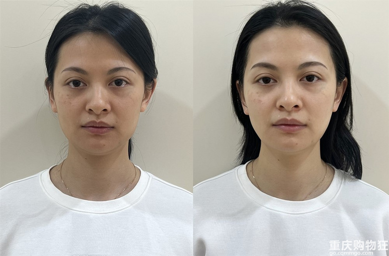 打探市妇幼保健院BBL PLUS！光子嫩肤界爱马仕，让皮肤光滑透亮-变美有招-重庆购物狂